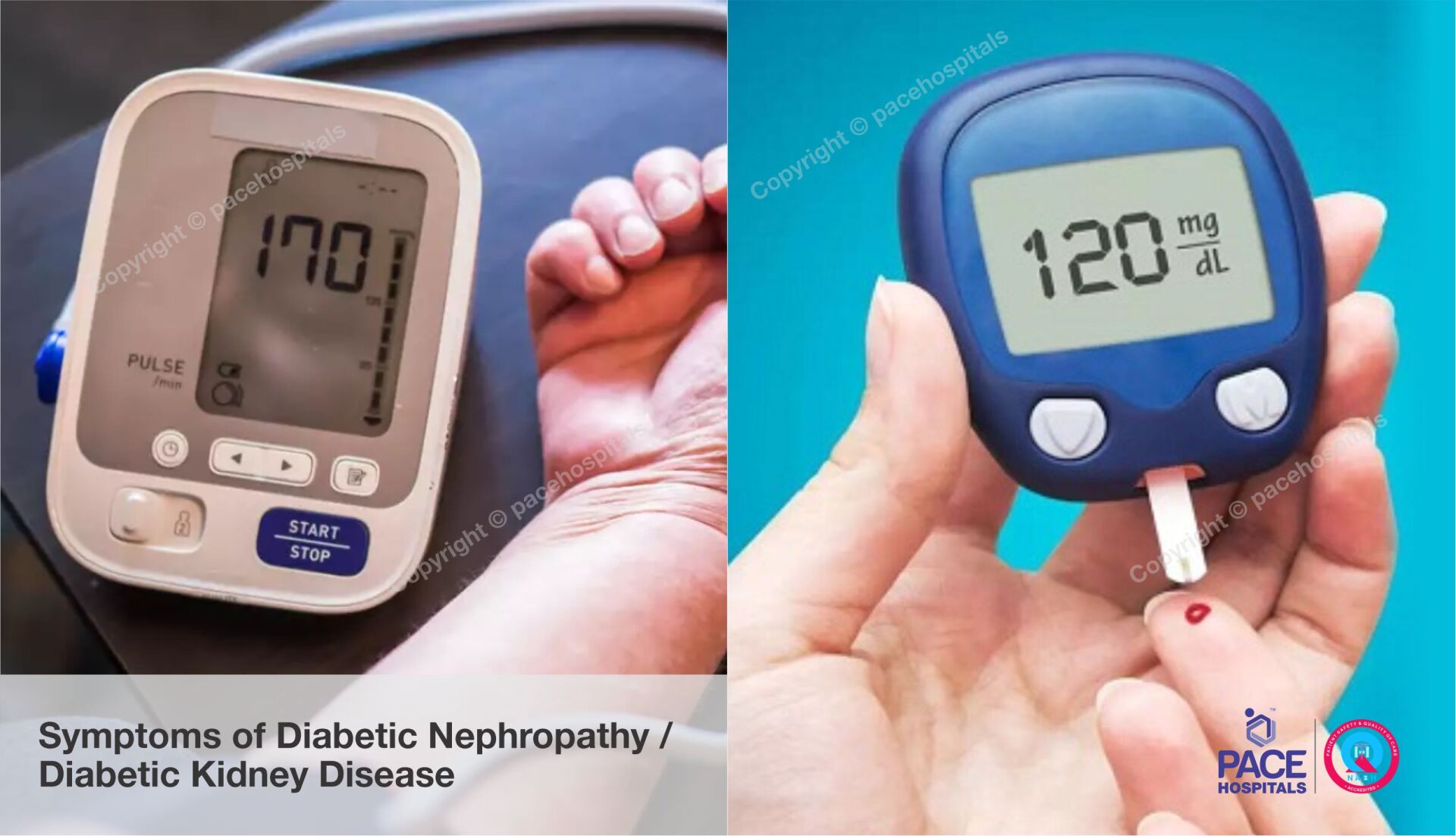 Diabetic Nephropathy: Symptoms, Causes, Diagnosis and treatment