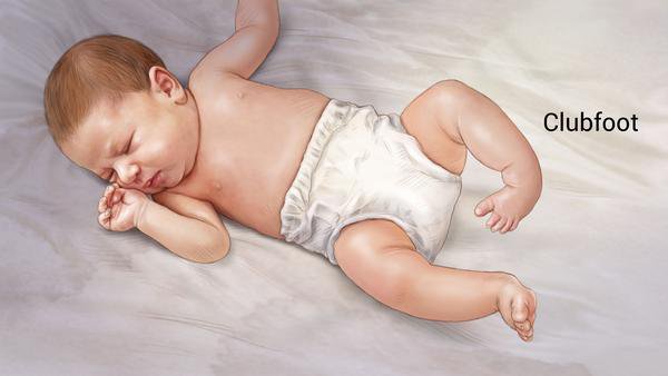 Early Detection of Neonatal Orthopaedic Disorders