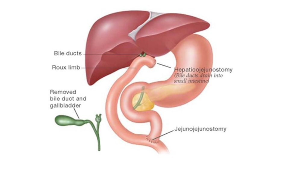 Right hepatectomy with ductoplasty and hepaticojejunostomy