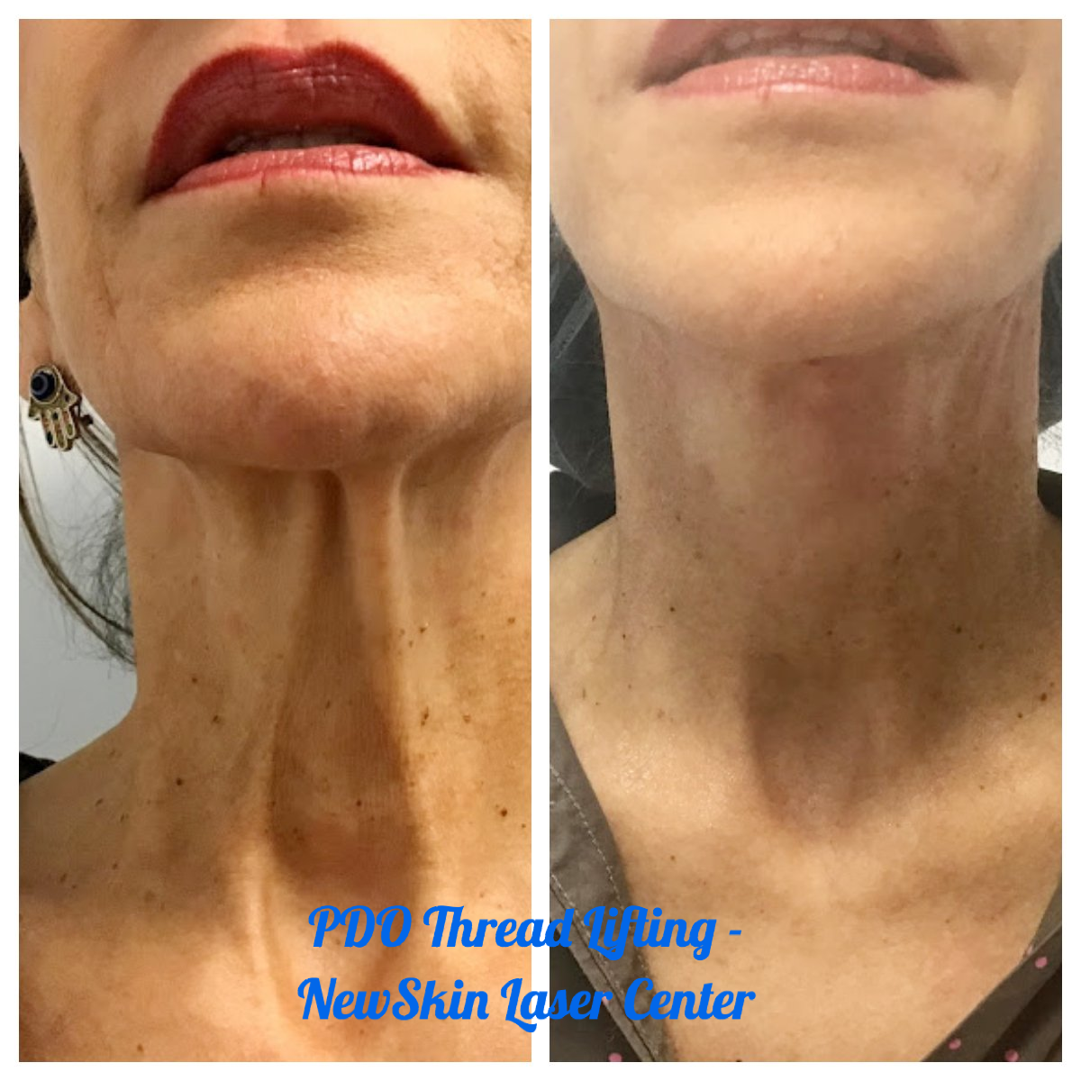 Before & After photo Northridge & Simi Valley | New Skin Laser Center