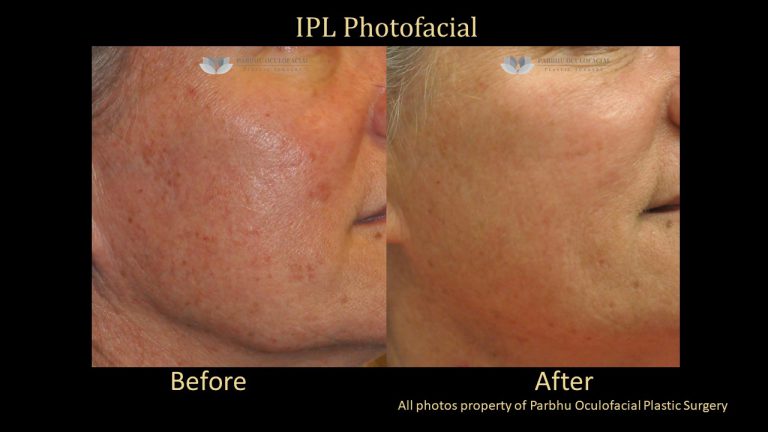 IPL Photofacial | Plastic Surgeon | Parbhu Oculofacial Plastic Surgery