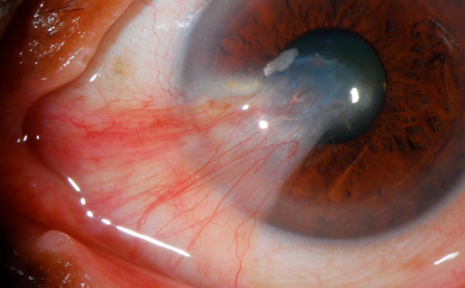 Pinguecula/Pterygia | Ophthalmologist in Windermere, FL | Remagin Institute
