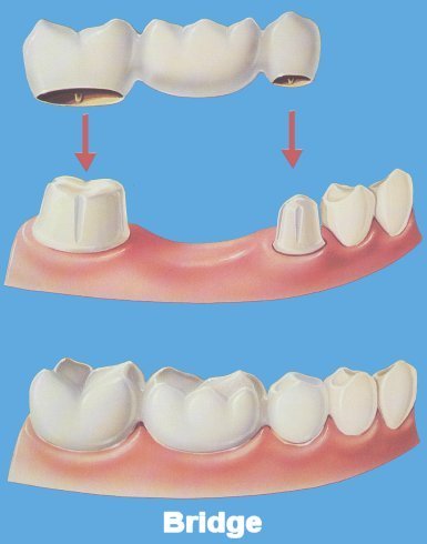 Is A Ceramic Bridge Right For You? | Harvard Dental Centre | Delta