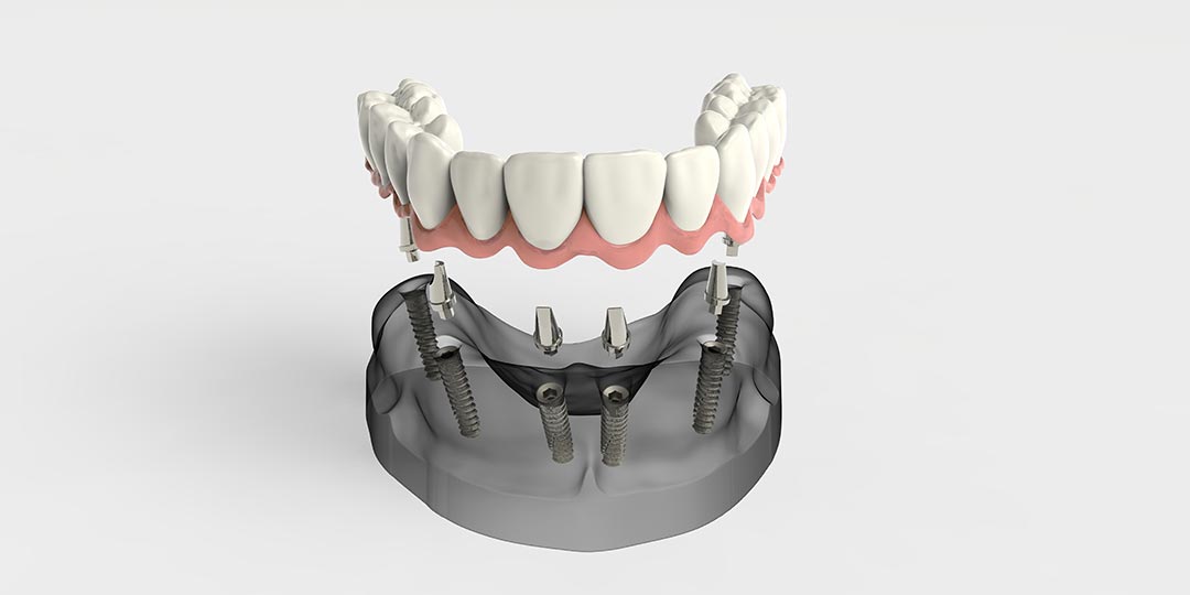 All-on-4™ Treatment Concept | Hawkesbury | Riverlands Dental