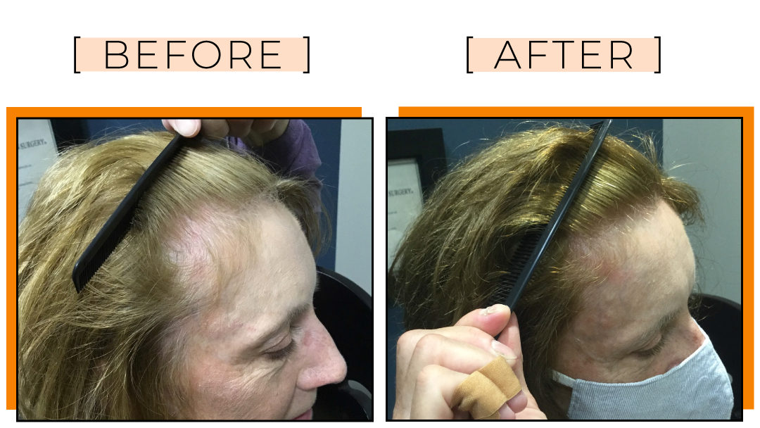 Chicago, IL Women's Hair Restoration Gallery | Dr. Yates Hair Science