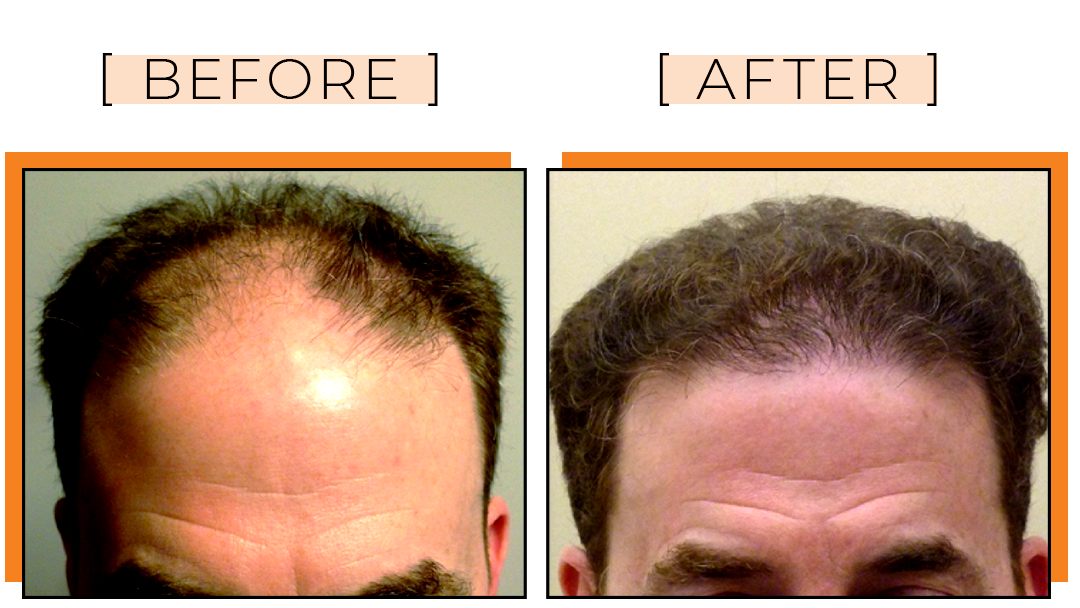 Chicago, IL Men's Hair Loss Gallery | Dr. Yates Hair Science