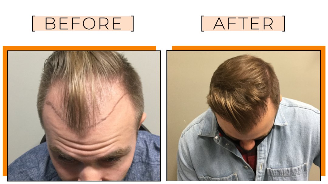 Chicago, IL Men's Hair Loss Gallery | Dr. Yates Hair Science