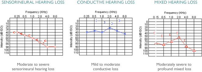 Hearing Center in Lincoln, RI and Uxbridge, MA - Blackstone Valley Hearing