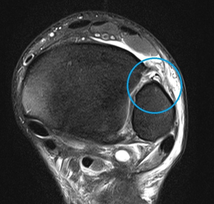 High Ankle Injury | Ankle | Dr Ben Beamond | Adelaide
