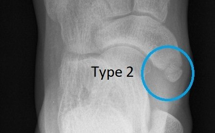 Accessory Navicular | Dr Ben Beamond | Adelaide