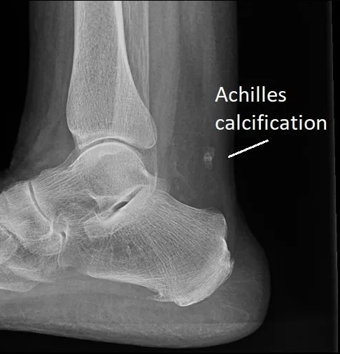 Achilles Tendinopathy | Dr Ben Beamond | Adelaide