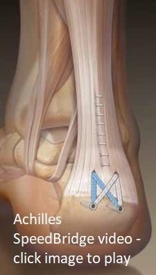 Achilles SpeedBridge | Dr Ben Beamond | Orthopaedic Surgeon | Adelaide