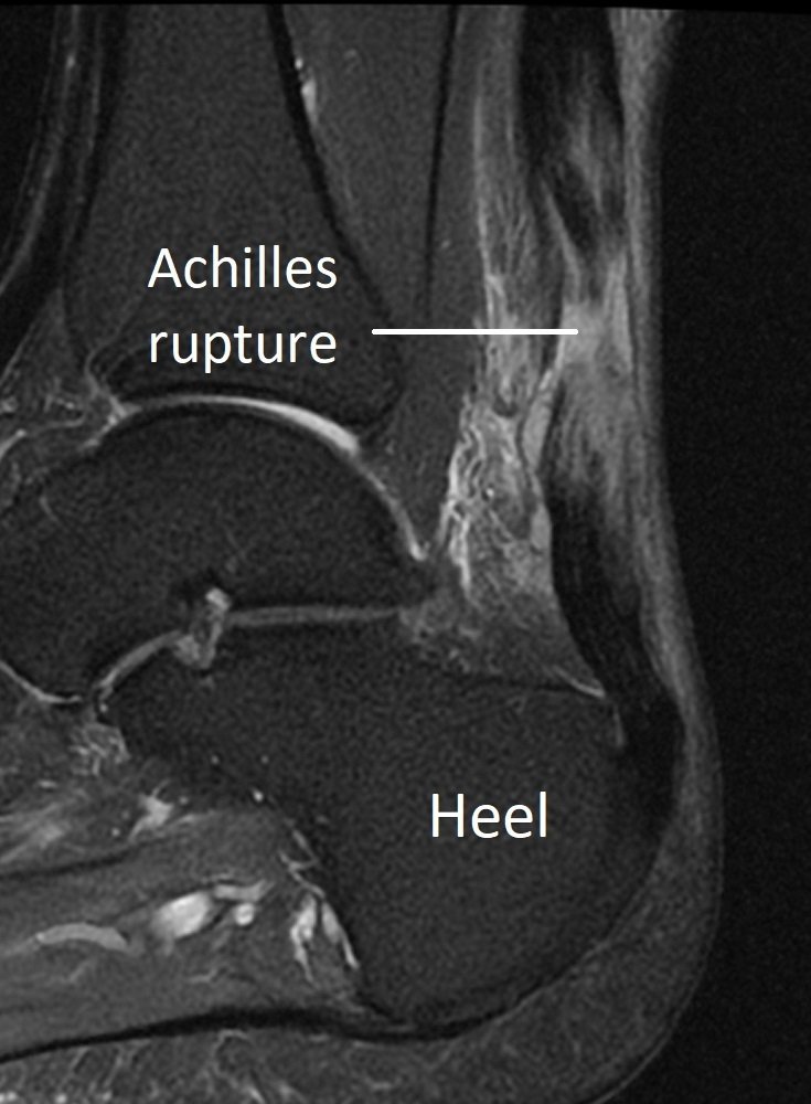 Achilles Tendon Rupture | Dr Ben Beamond | Adelaide