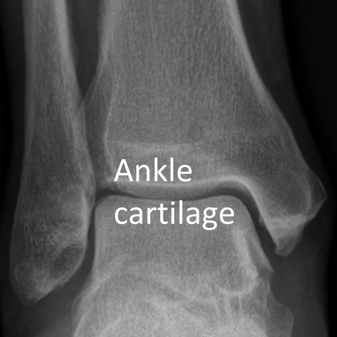 Ankle Cartilage Injury | Ankle | Dr Ben Beamond | Adelaide