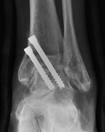 Ankle Fusion and Replacement | Dr Ben Beamond | Adelaide