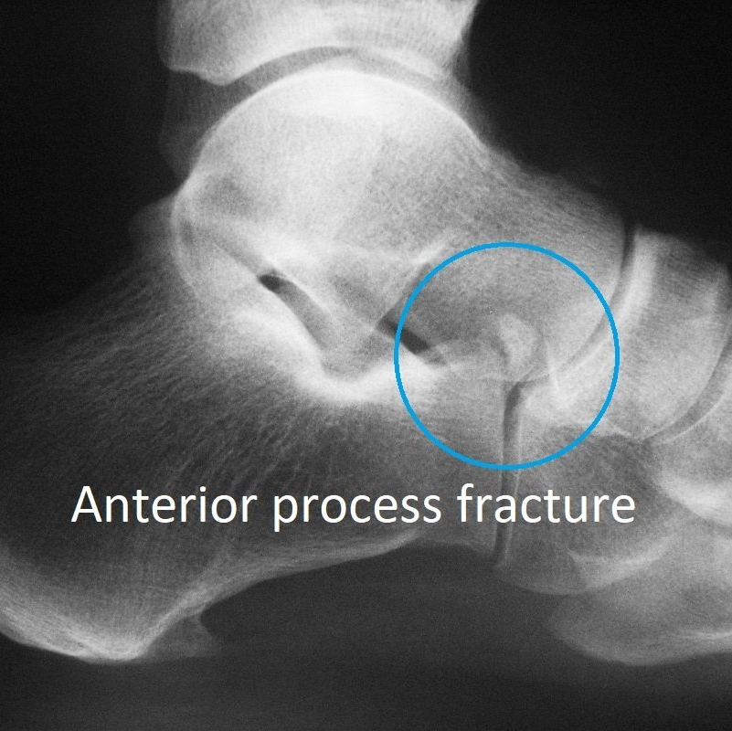 Calcaneus Fractures | Dr Ben Beamond | Adelaide