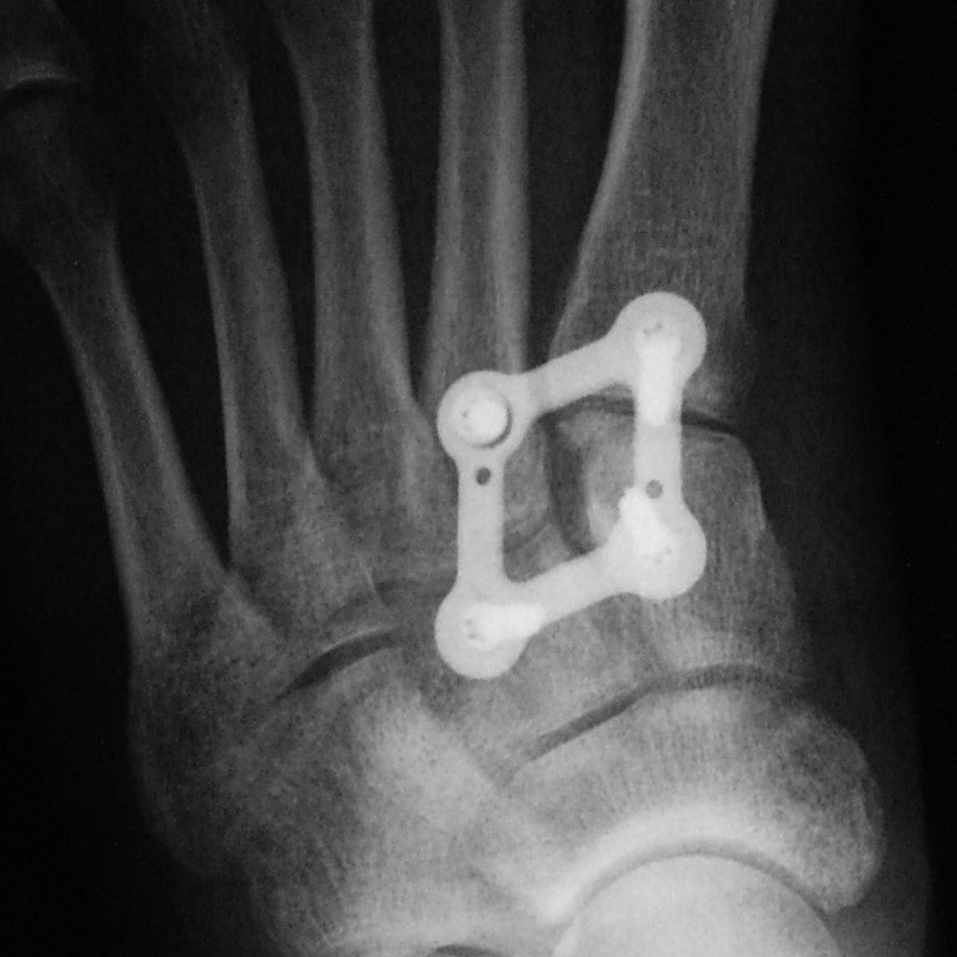 Lisfranc Stabilisation | Dr Ben Beamond | Adelaide