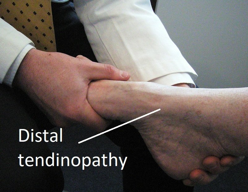 Tibialis Anterior Tendinopathy | Dr Ben Beamond | Adelaide