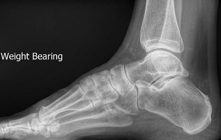 Peroneal Tendons | Ankle | Dr Ben Beamond | Adelaide