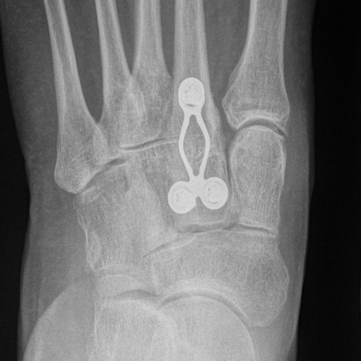 Midfoot and Hindfoot Fusion | Dr Ben Beamond | Adelaide