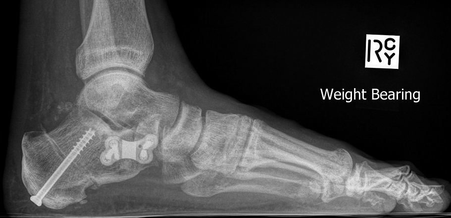 Flat Foot Reconstruction | Dr Ben Beamond | Adelaide