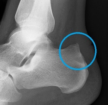 Haglund's Retrocalcaneal Bursitis | Dr Ben Beamond | Adelaide