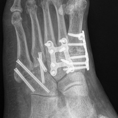 Midfoot and Hindfoot Fusion | Dr Ben Beamond | Adelaide