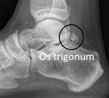 Ankle Spurs and Impingement | Ankle | Dr Ben Beamond | Adelaide