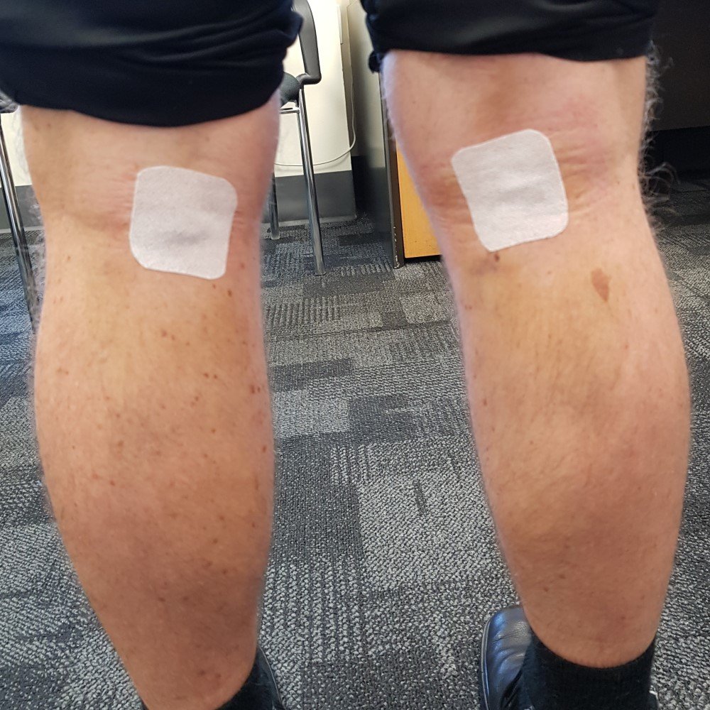 Plantar Fascia Surgery | Dr Ben Beamond | Adelaide