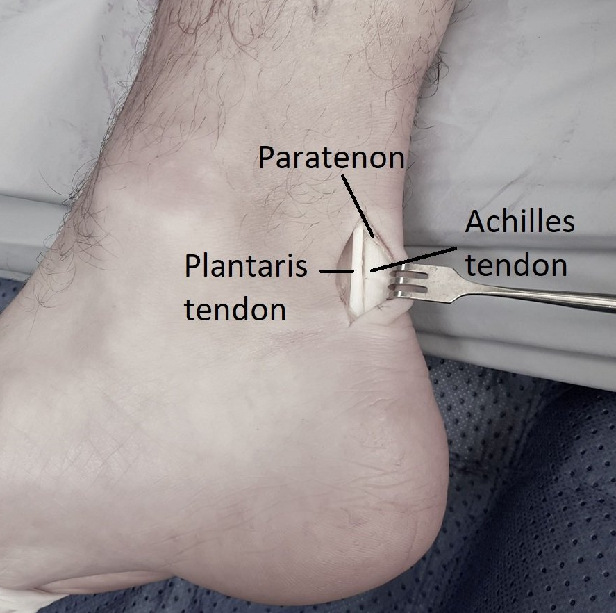 Paratenonitis and Plantaris | Dr Ben Beamond | Adelaide