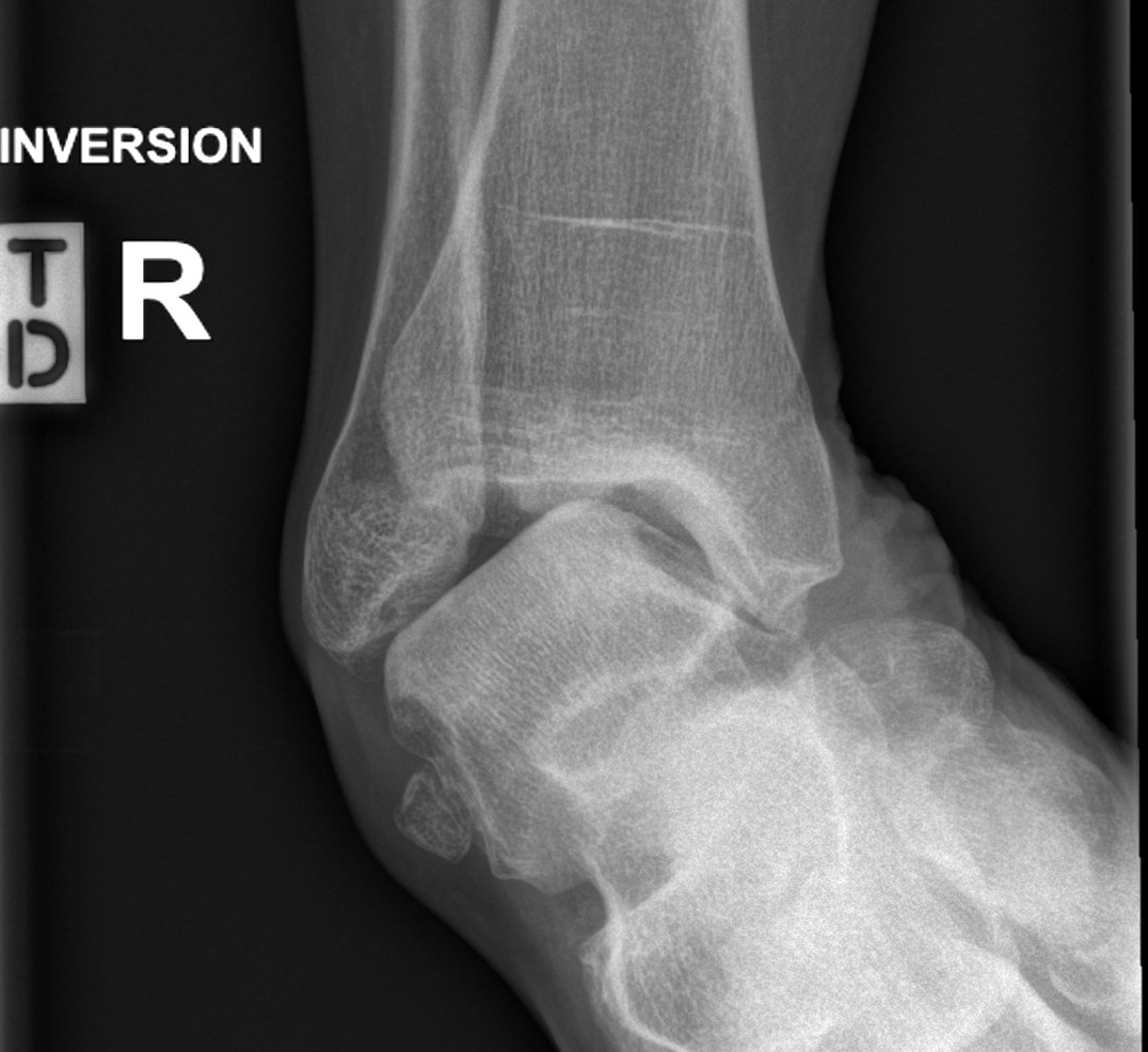 Peroneal Tendons | Ankle | Dr Ben Beamond | Adelaide