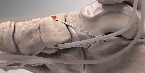 Flat Foot Reconstruction | Dr Ben Beamond | Adelaide