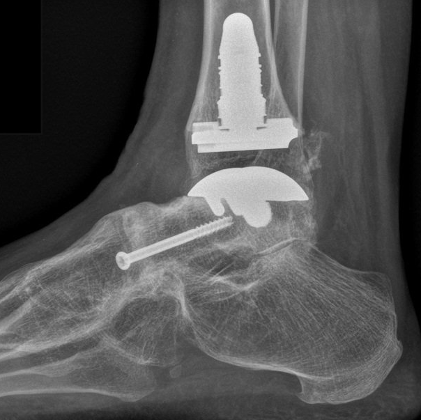 Ankle Fusion and Replacement | Dr Ben Beamond | Adelaide