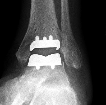 Ankle Fusion and Replacement | Dr Ben Beamond | Adelaide