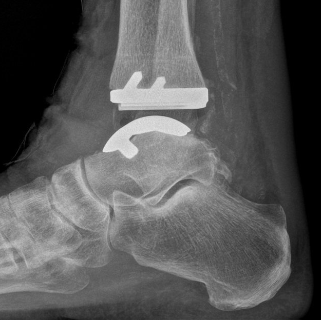 Ankle Fusion and Replacement | Dr Ben Beamond | Adelaide