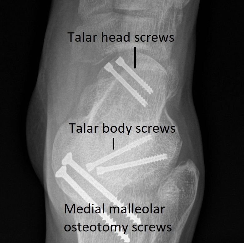 Tatus Fractures | Dr Ben Beamond | Adelaide