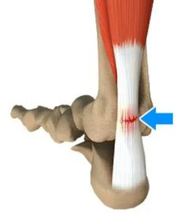 Achilles Tendon Rupture | Dr Ben Beamond | Adelaide