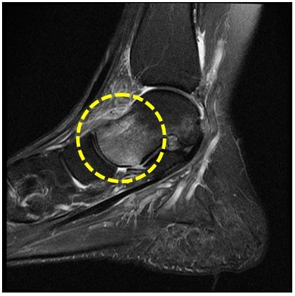 Why is my Ankle Sprain Not Getting Better?| Dr Ben Beamond | Adelaide