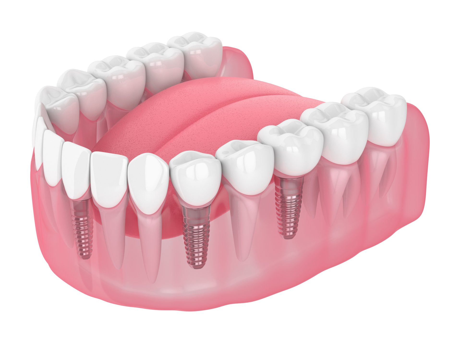Dental implant | Smile Tech