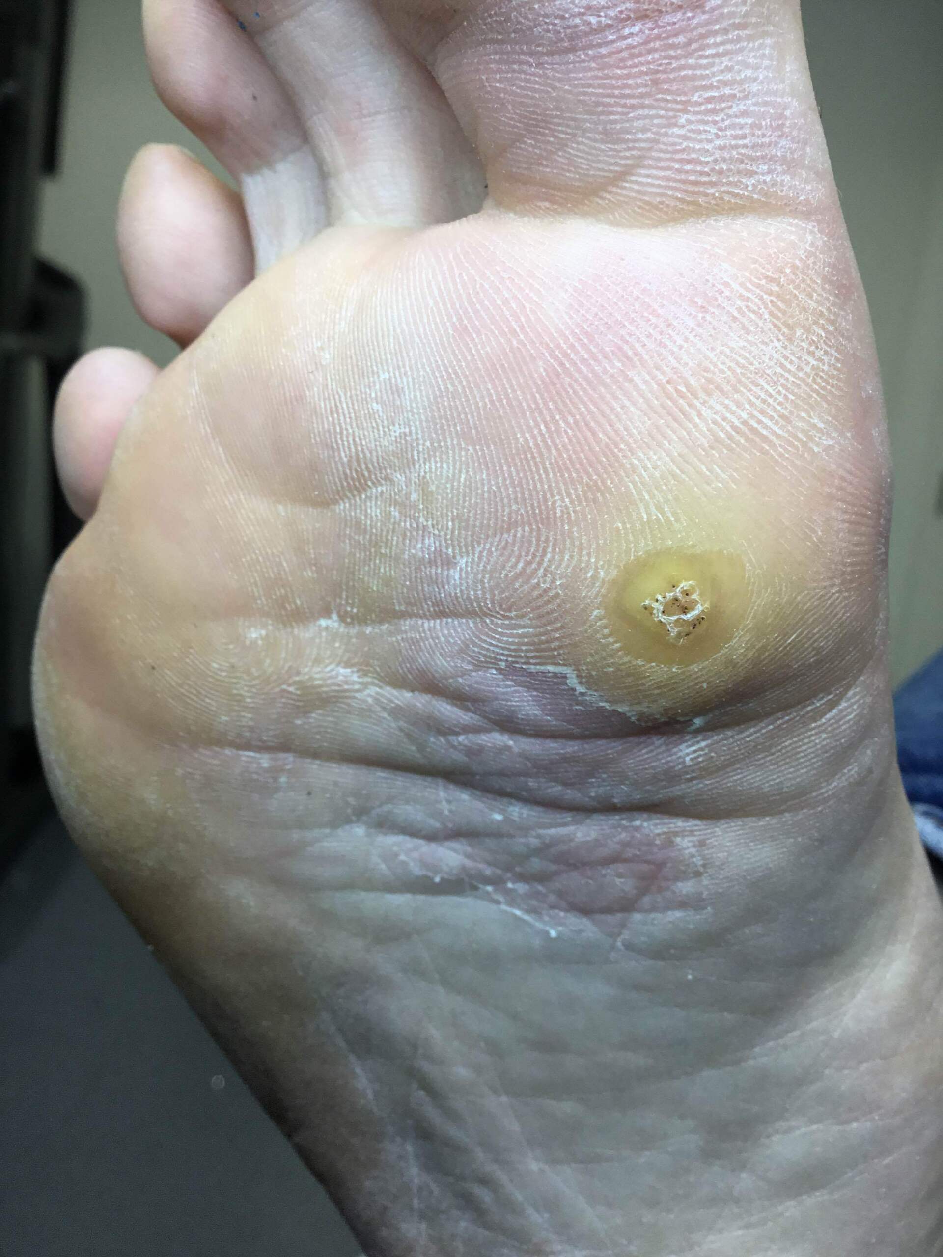 Swift Verruca Treatment - Whitley Bay | Bay Podiatry