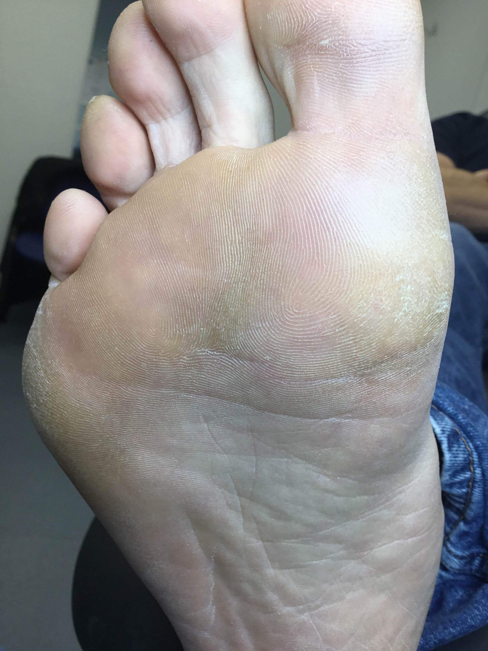 Swift Verruca Treatment - Whitley Bay | Bay Podiatry