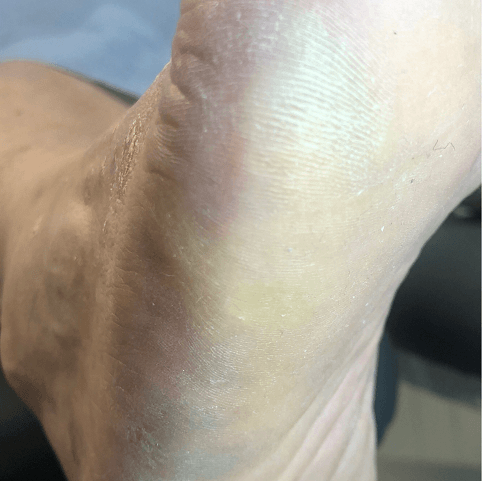 Swift Verruca Treatment - Whitley Bay | Bay Podiatry