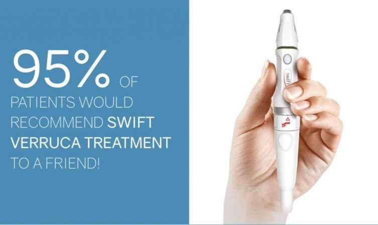Reliable swift microwave verruca treatment | Sally Pembery Associates