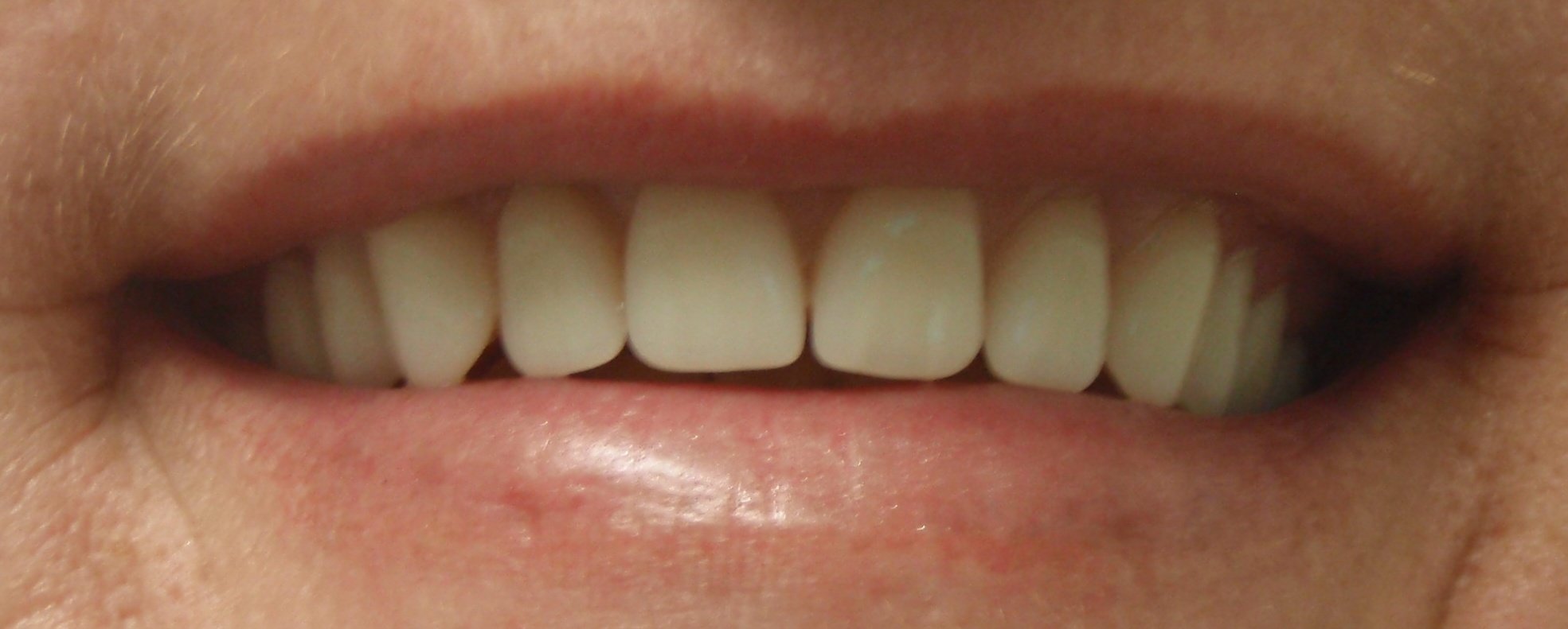 Gallery - Denture Clinic Gold Coast | Denture Doctor