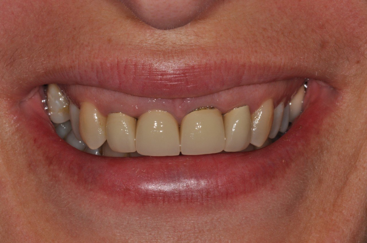 Fixed Bridges | Discover Dental Wellington