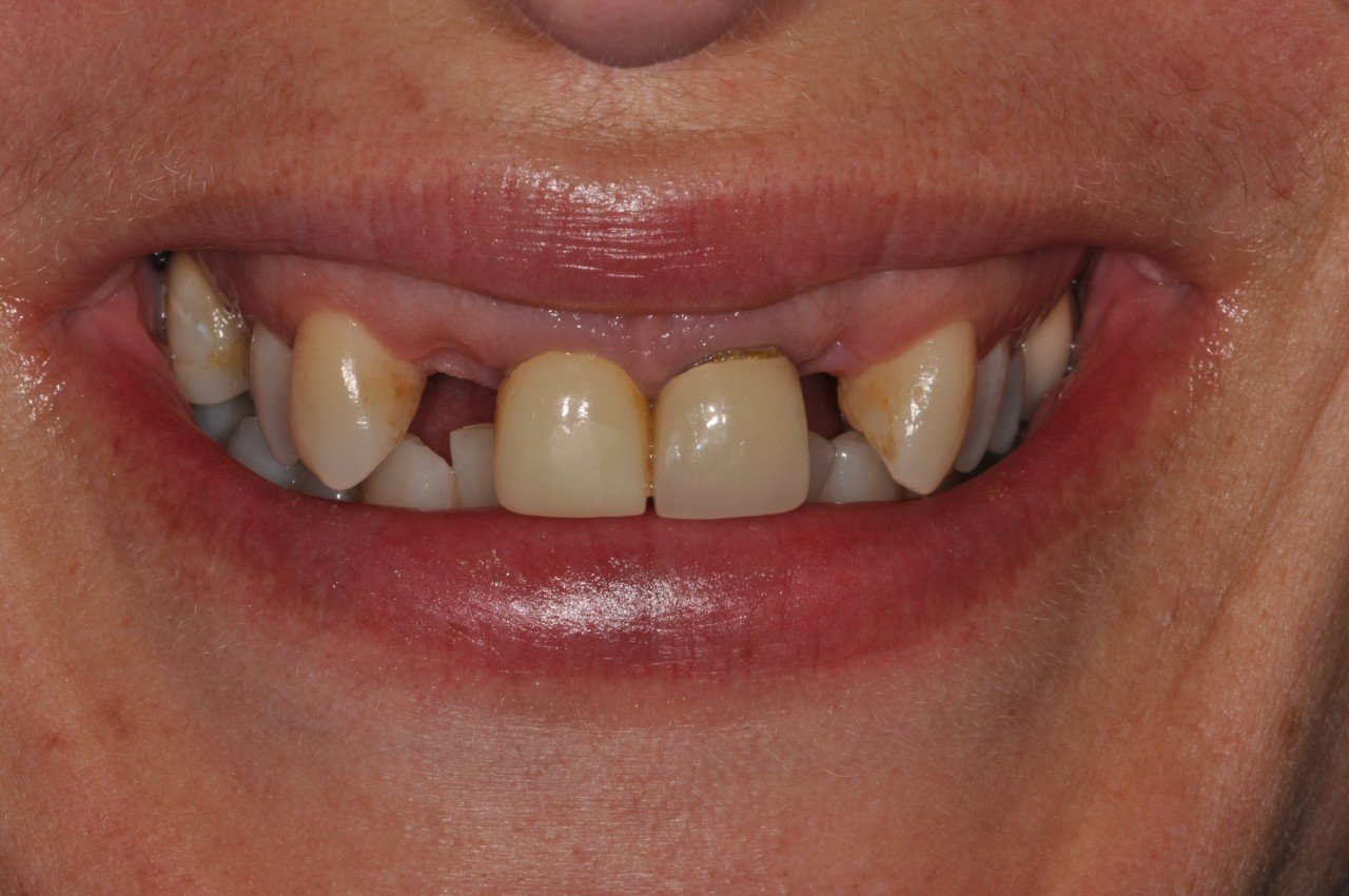 Fixed Bridges | Discover Dental Wellington