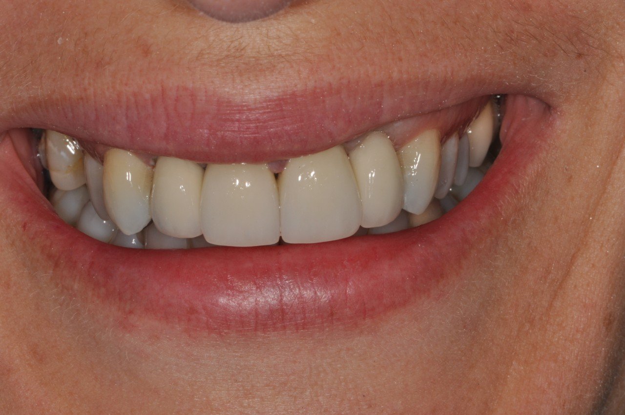 Fixed Bridges | Discover Dental Wellington