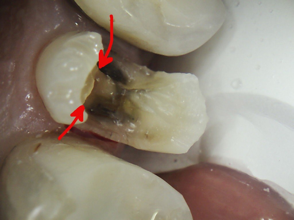 Fibre-Reinforced Composite Fillings | Discover Dental Wellington