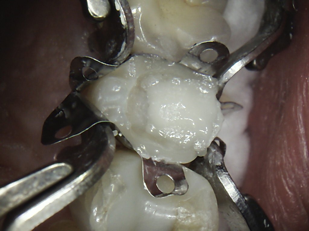 Fibre-Reinforced Composite Fillings | Discover Dental Wellington
