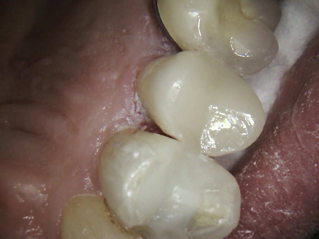 Fibre-Reinforced Composite Fillings | Discover Dental Wellington